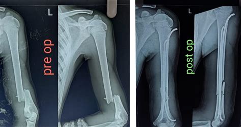 Bless Hospital Lower Third Displaced Humerus Fracture In