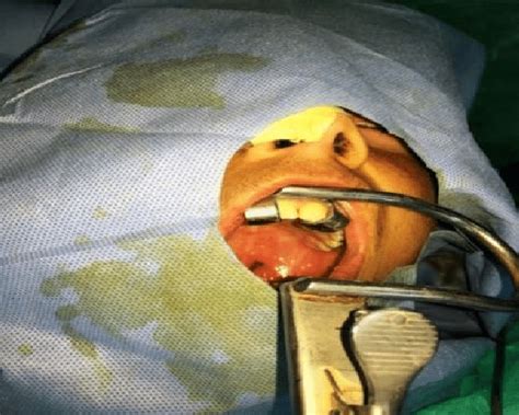 Left Tonsillectomy By Dissection Method Was Done Then Opening The Of