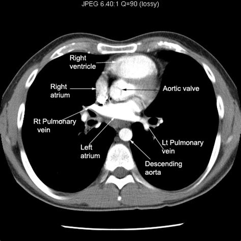Right Pulmonary Artery Anatomy Right Pulmonary Artery Anatomy