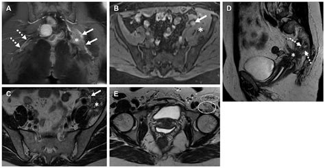 Mri Helps Clinicians Assess Neural Involvement In Endometriosis