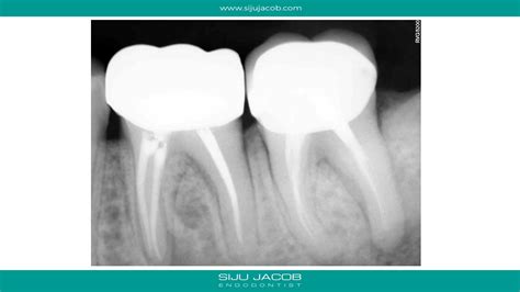 Selective Re Treatment Of Distal Root Tdo University