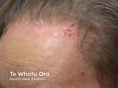 Psoriasis Forehead Is Novartis Psoriasis Drug Going To Steal Humiras