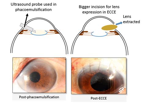 Cataract Surgery Diagnosis Procedure And Care Nuh Singapore