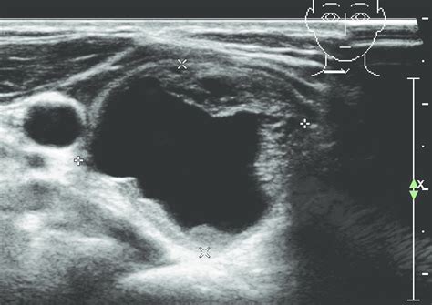 A Complex Cyst 10 Ml Before Pei B Solid Residue 04ml 6 Months