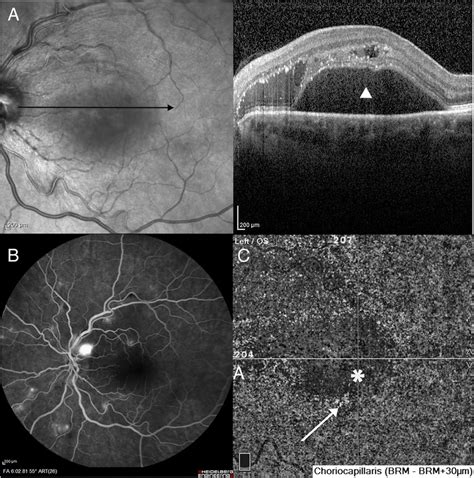 Exams At Baseline A Ss Oct B Scan Demonstrates Extensive Exudative
