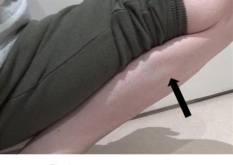 Rippling Muscle Disease Causes Symptoms And Cure Iryz