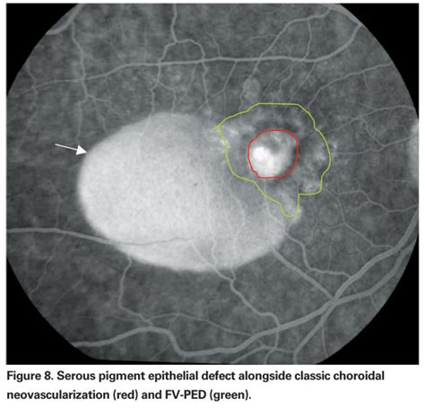 Choroidal Neovascular Membrane Oct