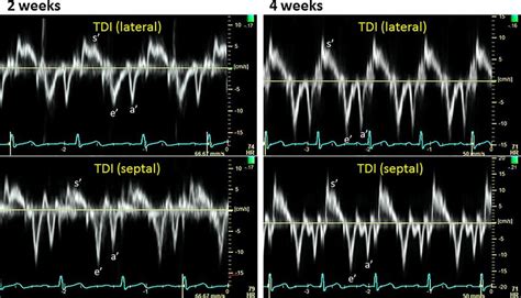 Tissue Doppler Profiles For The Lateral Top And Septal Bottom