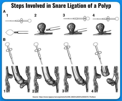 Klaus Mönkemüller On Linkedin 🔍 Essential Guide Advanced Polypectomy Techniques Key Steps For…