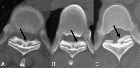 Dural Ossification Associated With Ossification Of Ligamentum Flavum In