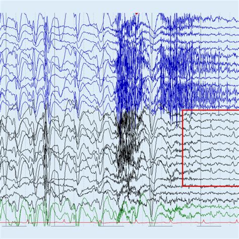 Eeg Of The Neonate Showing Suppression Burst Pattern Discussion Clarke Download Scientific