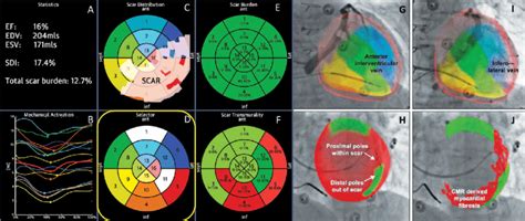 A Top Left Anteroposterior Venogram With Overlay Of Cmr Derived