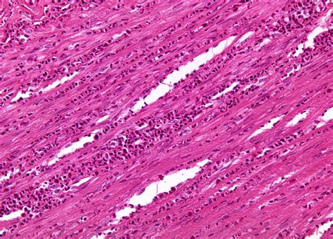 Suppurative Appendicitis At 20x Magnification Nikons Microscopyu