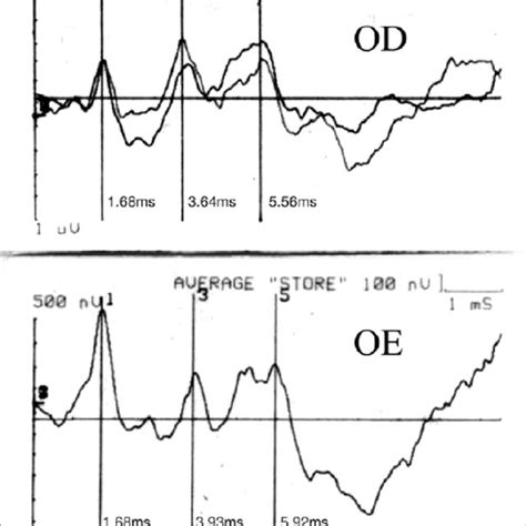 Abrs Suggestion Of A Retrocochlear Lesion Motivated Us To Order The