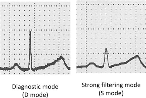 心电图（ecg）滤波器对儿童r波和t波高度的影响scientific Reports X Mol