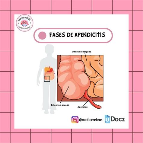 Fases De Apendicitis Aguda Medicerebros Udocz