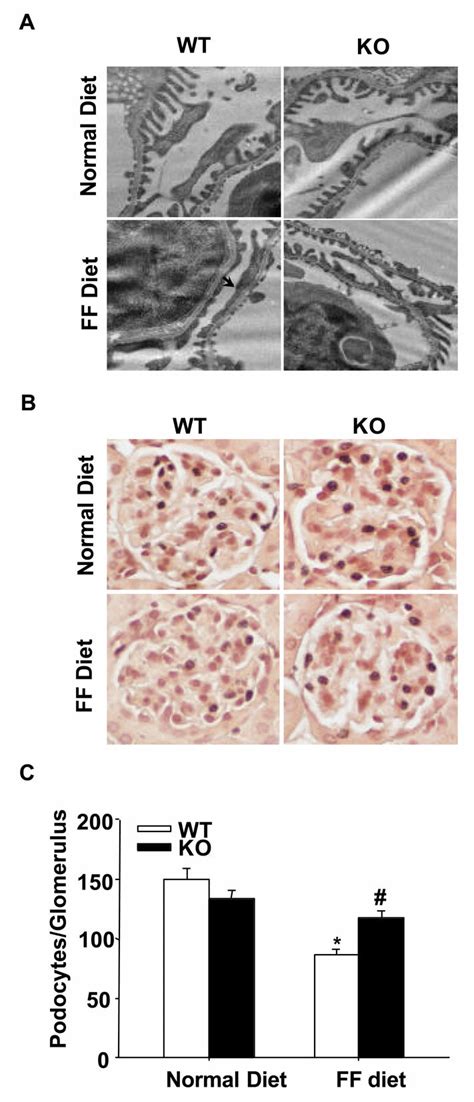 Attenuation Of Foot Process Effacement And Podocyte Loss In The