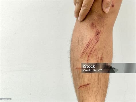 남자의 다리에 사고는 정원에서 스크래치입니다 흰색 배경에 혈액과 고통스러운 다리 상처 사고 복사 공간 50 59세에 대한 스톡