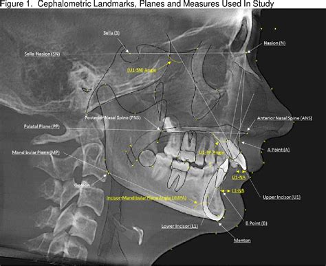 Figure 1 From A Retrospective Analysis Of Pre Surgical Incisor