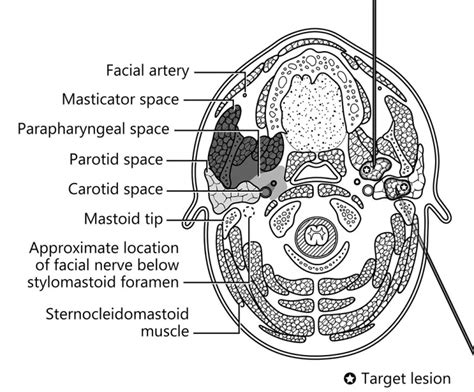 Pathology Through Anatomy—imaging The Suprahyoid Neck Spaces Arrs