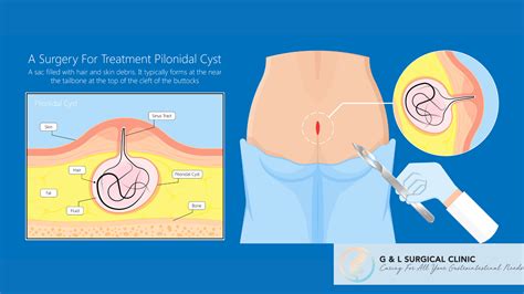Pilonidal Cystectomy Surgery Singapore Gandl Surgical Clinic Dr Ganesh