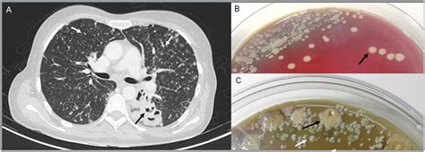 Constitutional Syndrome And Miliary Pattern In An Hiv Positive Patient Enfermedades