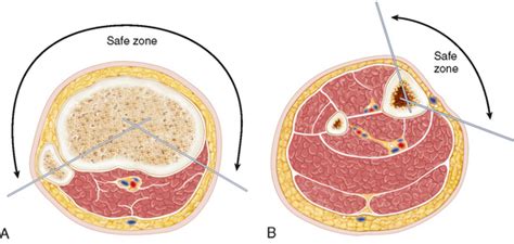 30 Proximal Tibia Fractures External Fixation II Musculoskeletal Key