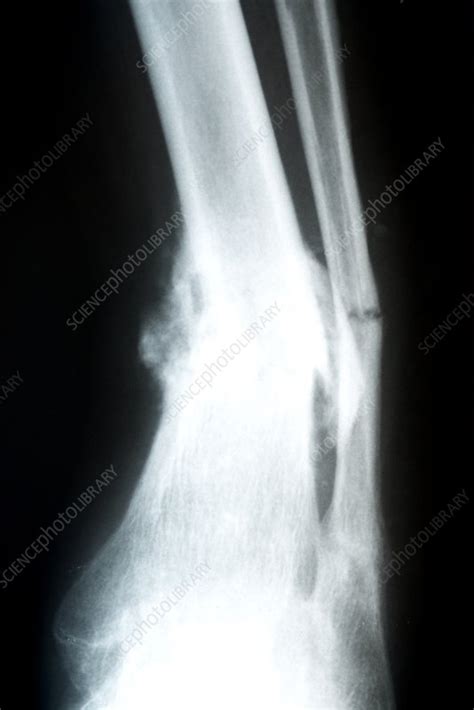 X Ray Of Fractured Tibia And Fibula Stock Image C021 3383 Science Photo Library