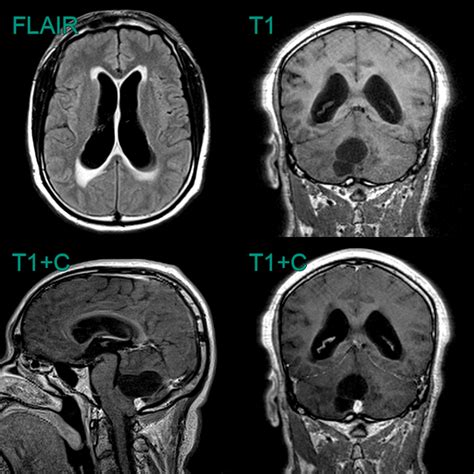 Haemangioblastoma Neuroradiology