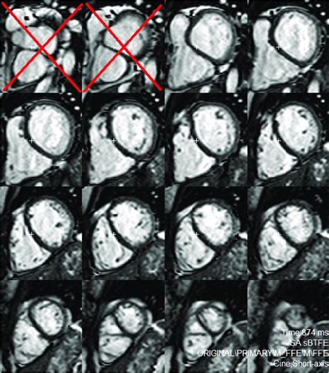 Example Of Segmentation Of The Shortaxis Slices Using Segment Slices