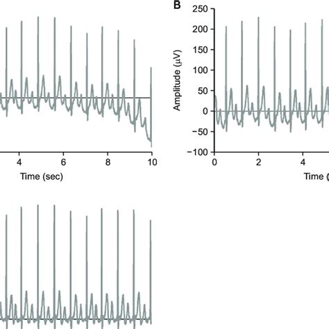 Preprocessing Of An Ecg Waveform A Original Waveform B After Download Scientific Diagram