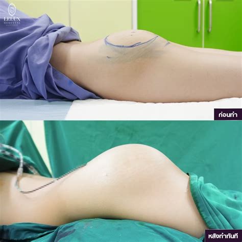 Buttock Augmentation Gallery Lelux Hospital