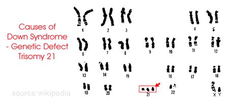 Down Syndrome Trisomy 21 Causes Symptoms Diagnosis Treatment