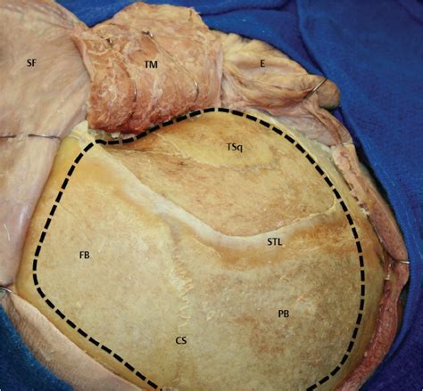 Trauma Flap And Osteo Dural Decompression Techniques Neupsy Key