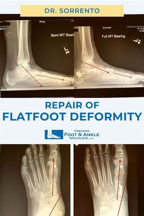 Flatfoot Deformity Ankle Surgery Flat Feet Deformed Sorrento
