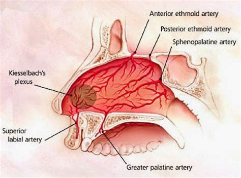 What To Do If You Have A Nose Bleed