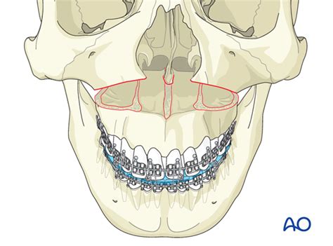 Le Fort I Osteotomy For Maxillary Retrognathism