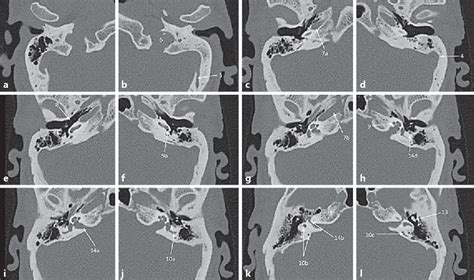 Figure 1 From Eight Items To Check On A Temporal Bone Ct Scan Semantic Scholar