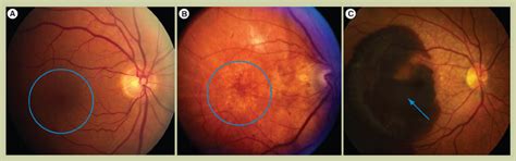 Fundus Photographs In Age Related Macular Degeneration Patients Download Scientific Diagram