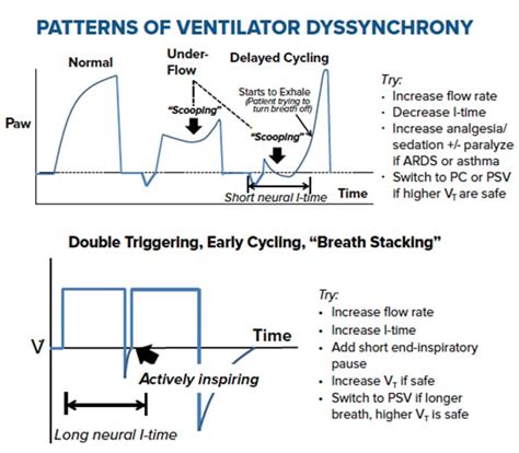 Your First Shift In The Unit Demystifying Ventilator Alarms Emra