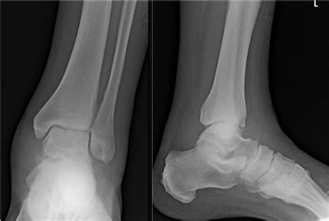 Figure 1 From A Rare Case Of Osteomyelitis Of An Ankle Caused By