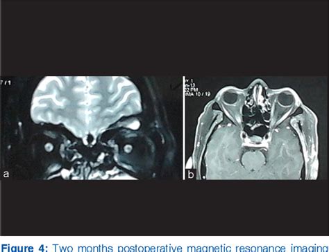 Figure 4 From Unusual Case Of Temporal Dermoid Cyst Presenting As Oculomotor Nerve Palsy