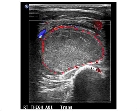Single Sonographic Image With Color Doppler Demonstrates A Large Download Scientific Diagram