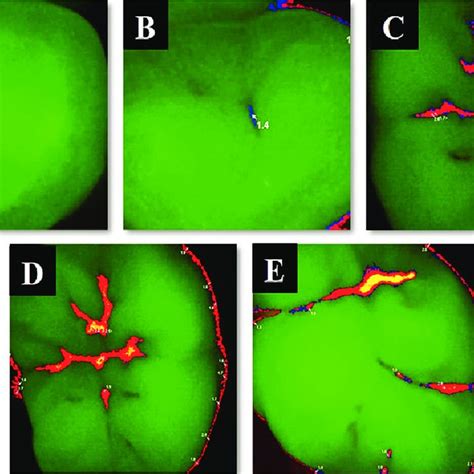 A E Icdas Ii Scoring System Representing Score From 0 4 With Download Scientific Diagram