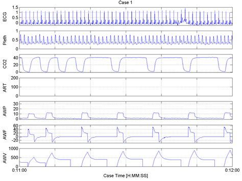 Case 1 Waveform Plots 60 Second Plots