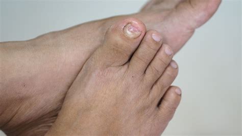 How To Treat Nail Infection At Home Safely Health Makes You