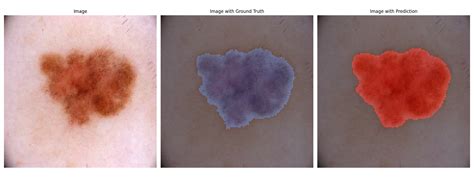 Melanoma Segmentation · Pypi