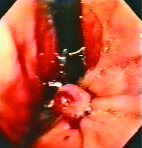 A Dieulafoy Lesion On The Lesser Cur− Vature Of The Stomach After Two