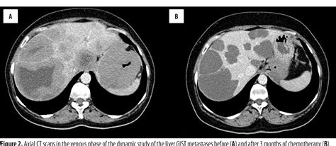 Figure 2 From Evaluation Of Alterations In Tumor Tissue Of Gastrointestinal Stromal Tumor GIST