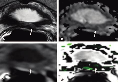 Local Tumor Recurrence After Prostatectomy Seen On Multiparametric Mri Download Scientific